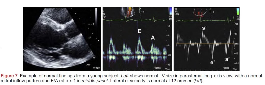 New recommendations for the evaluation of left ventricular diastolic ...